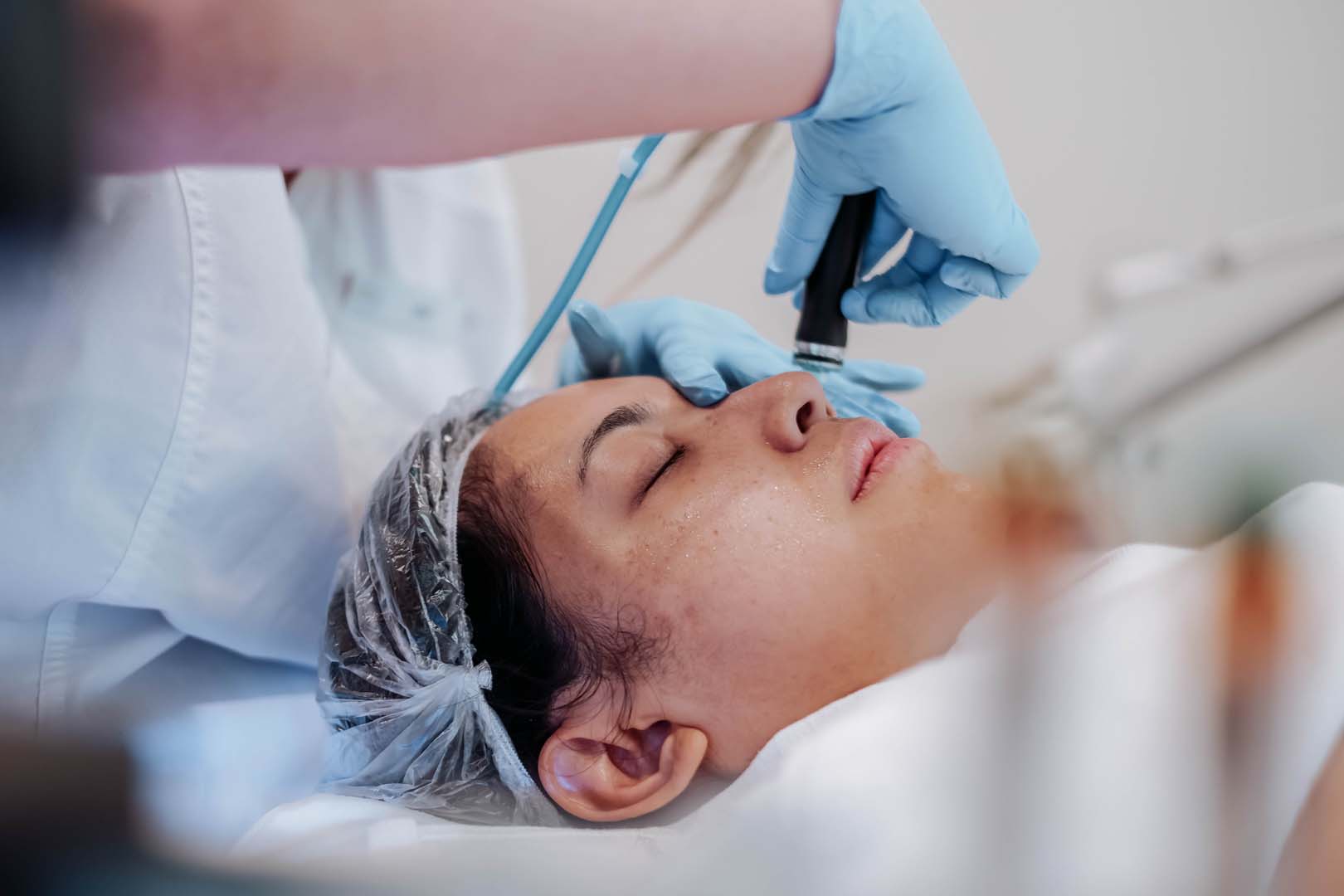 Best acne scar treatment | Dermstetiq Clinic