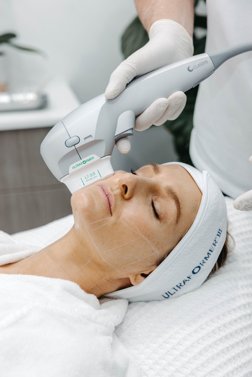 Hyperpigmentation on face | Ultraformer III HIFU